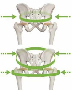 Zum Einsatz von Beckenkompressionsbandagen in Orthopädie und ...