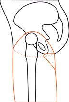 Biomechanische Funktionen des Tuberaufsitzes in der Beinorthetik ...