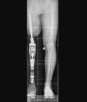 Die Endo-Exo-Versorgung als Alternative zur Schaftprothese ...
