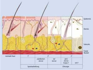 Verbrennung Archive - Verlag Orthopädie-Technik